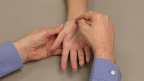 UVM | Sindrome del tunnel carpale: sintomi e approccio chirurgico